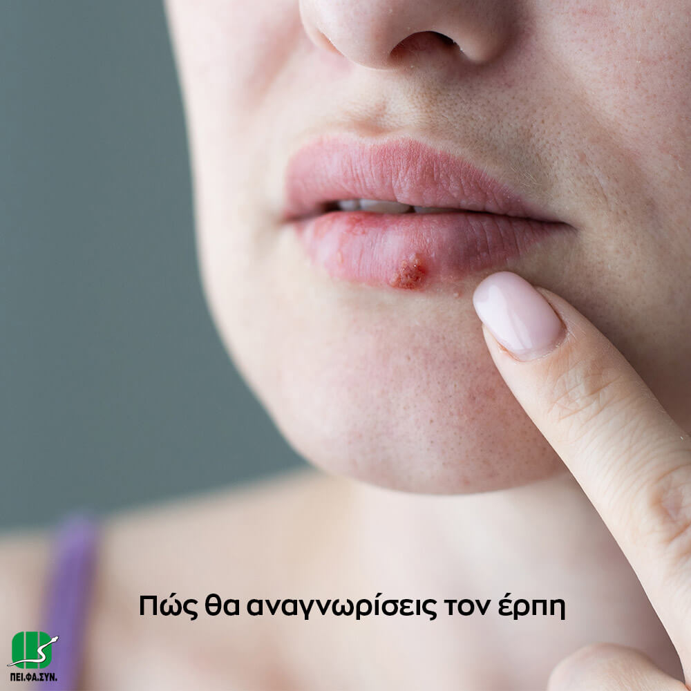 Πώς θα αναγνωρίσεις τον έρπη - peifasyn.gr | Καλώς ήρθατε στον όμιλο ...